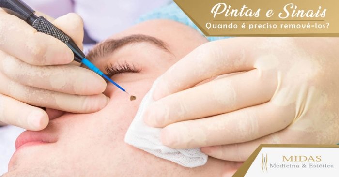 Quando é preciso remover as Pintas e os Sinais? - Midas Medicina ...